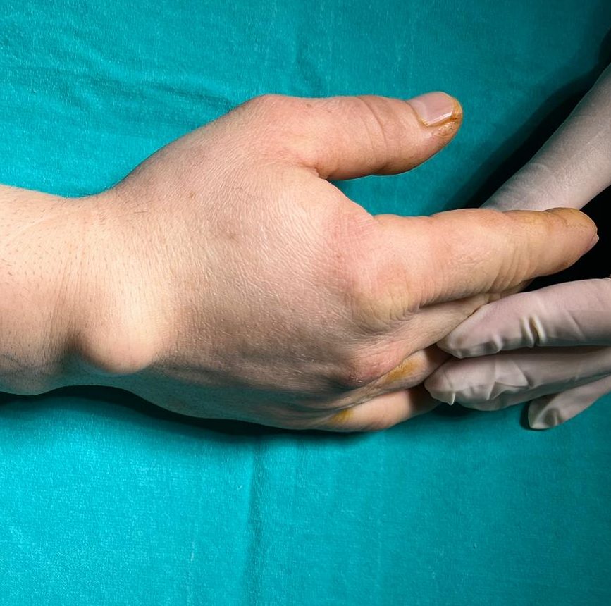 Ganglion Kisti - El Cerrahi